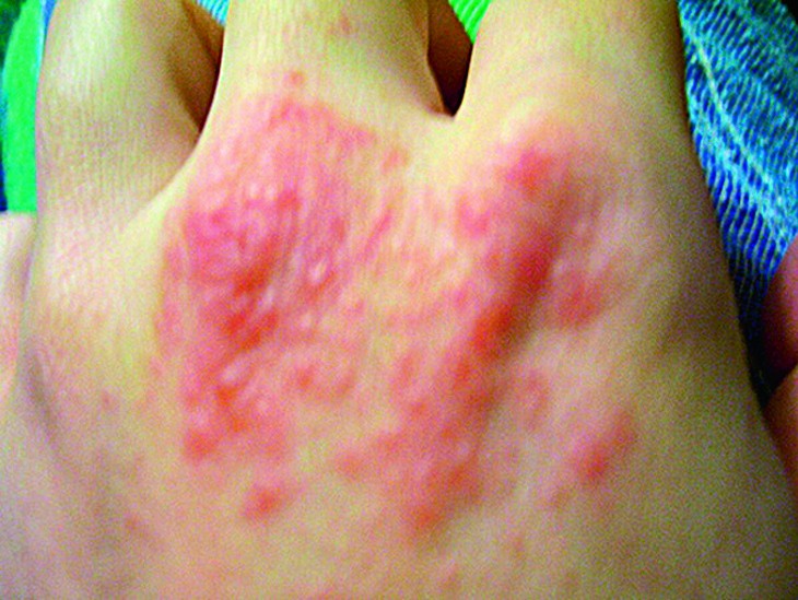 Fotodermatoos | Haiguste ABC - Kliinik.ee